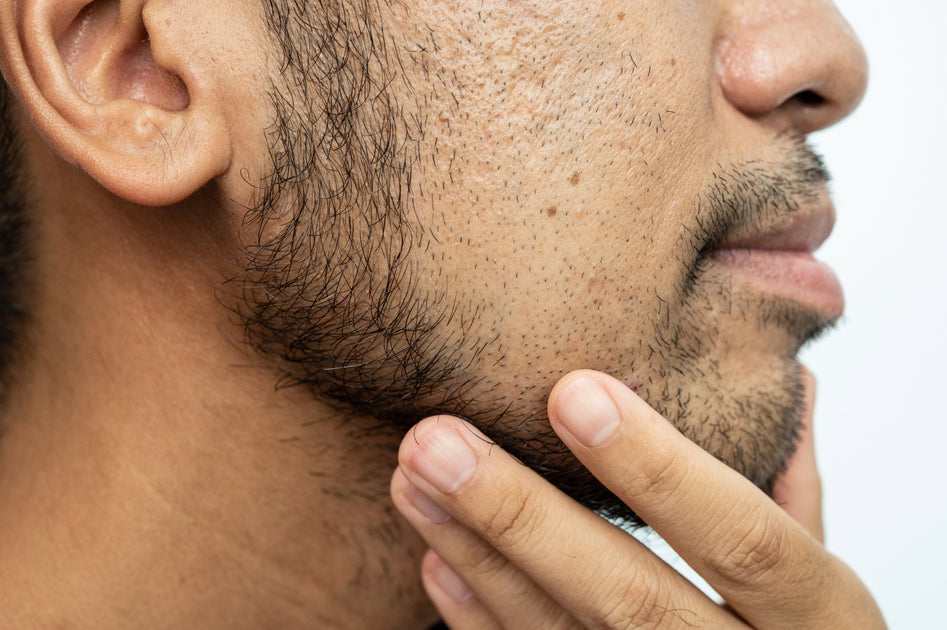 Beard Acne: What It Is, Causes, and How To Fix It – The Beard Club